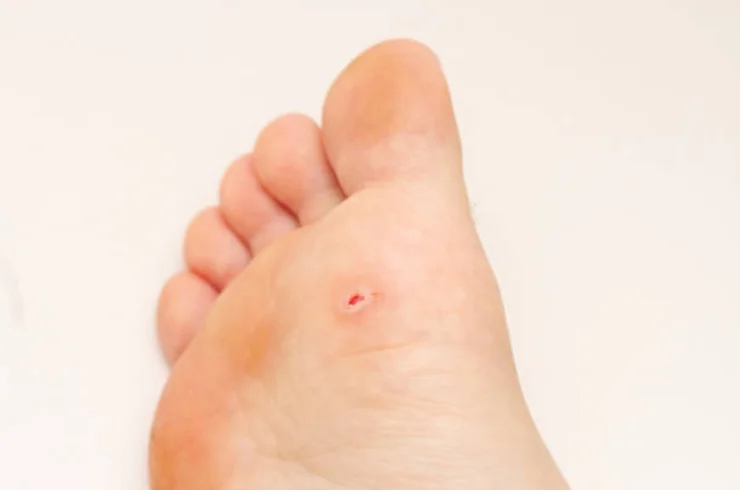 Corn Excision - Amvi Clinic